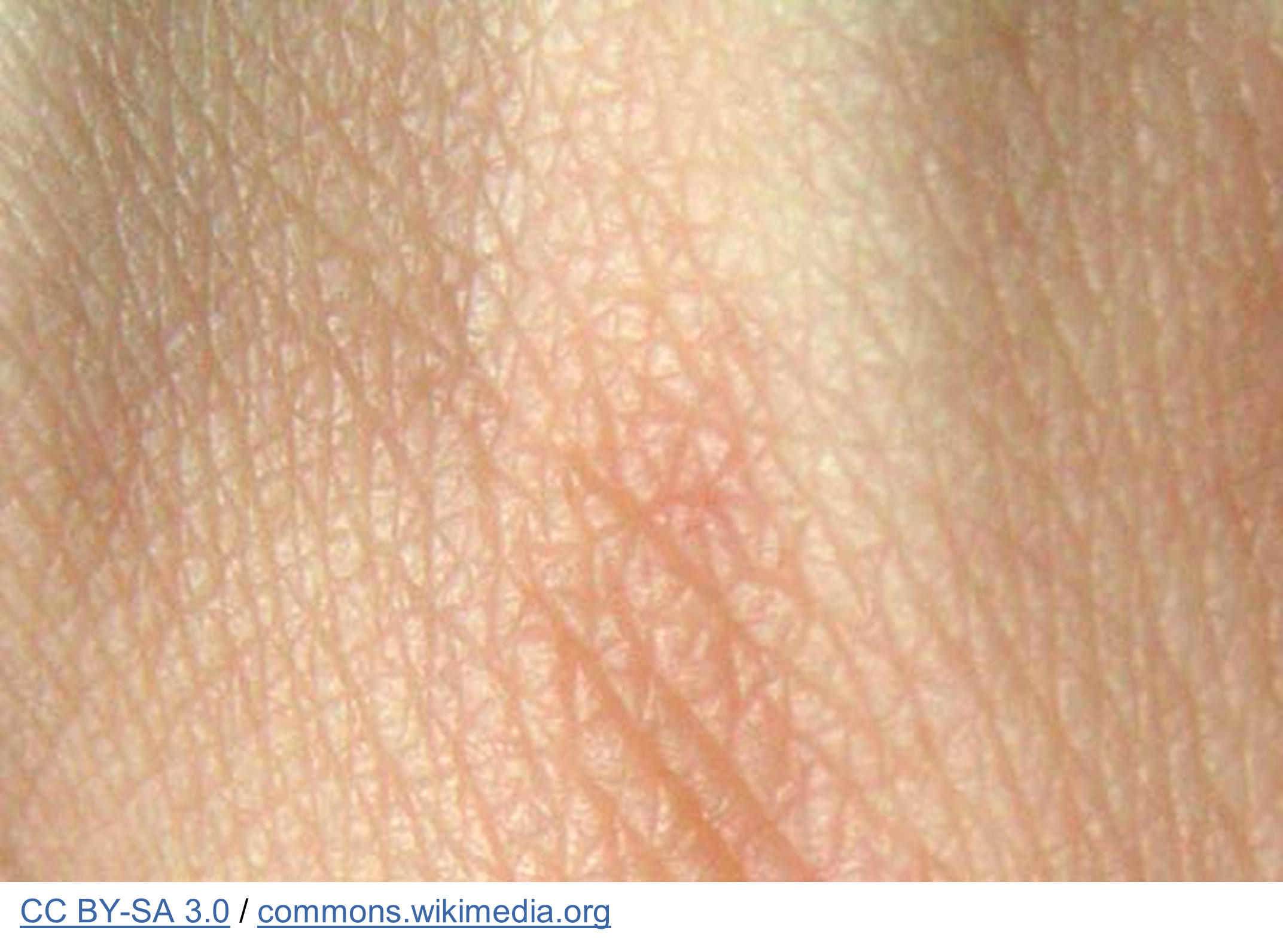The Pressure is On! Prevent Pressure Injuries and Promote Skin Health ...
